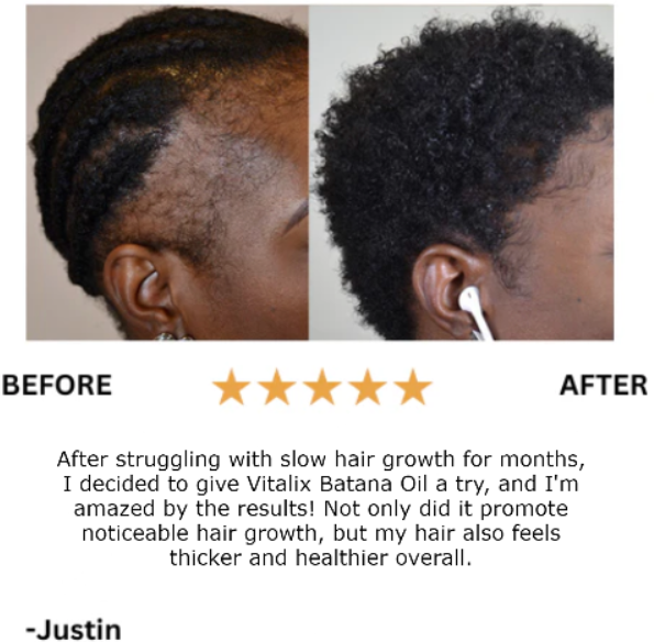 Vitalix Natural Hair Growth Oil – Vitalix Hair Growth Solution